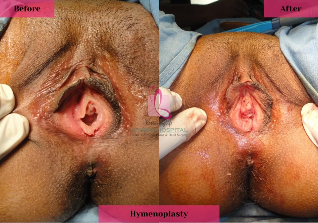 Vaginal Cosmetic Surgery - Bembde Hospital