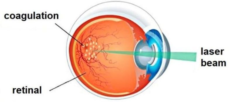 Ophthalmology & Retinal Surgery - Bembde Hospital
